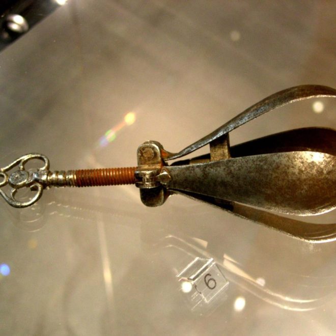 Essie Dunbar: The Woman Who Lived for Another 40 Years After Being ...