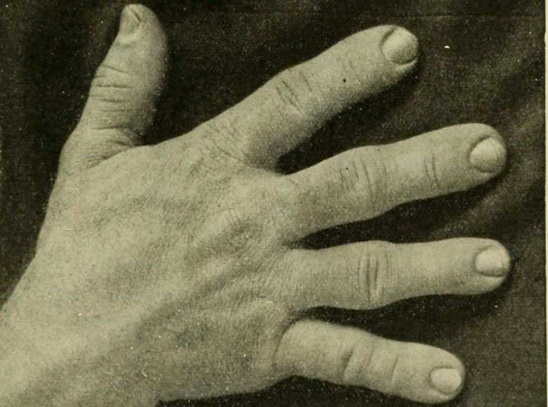 The Strange Story of Adam Rainer: The Man Who Was Born a Dwarf And ...