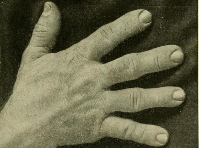 The Strange Story of Adam Rainer: The Man Who Was Born a Dwarf And ...