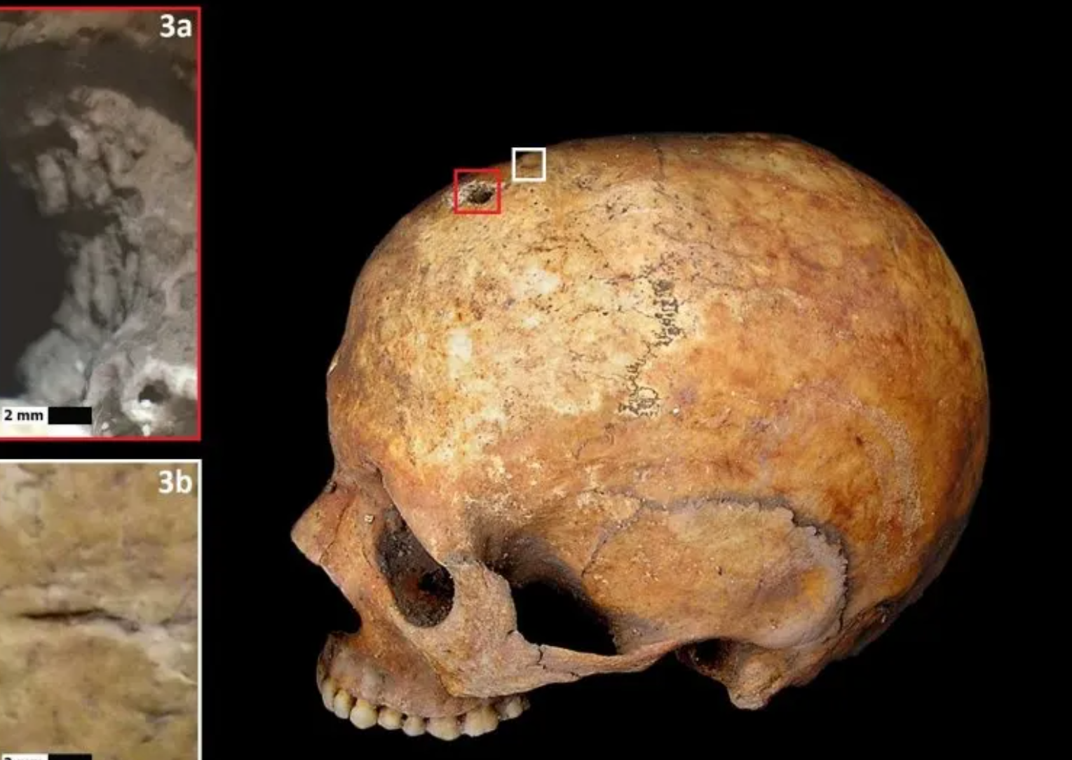 Coffin Birth: A Rare Postmortem Phenomenon