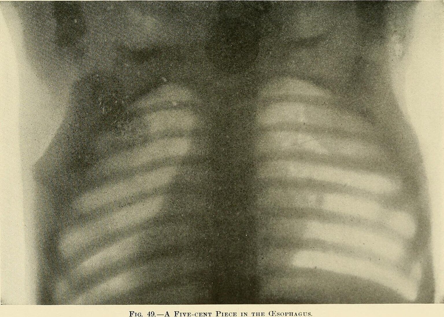 Wilhelm Conrad Röntgen: The Inventor of the X-ray